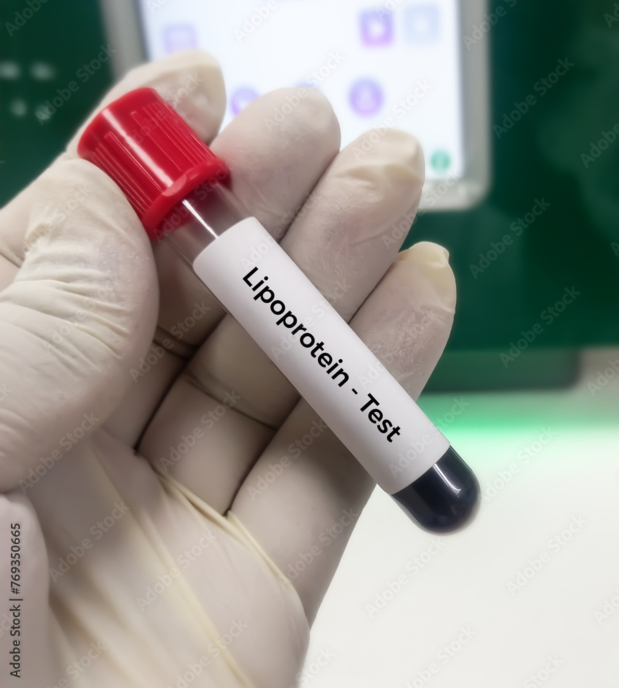 Foto de Blood sample for lipoprotein test. Lipid profile. to diagnosis ...