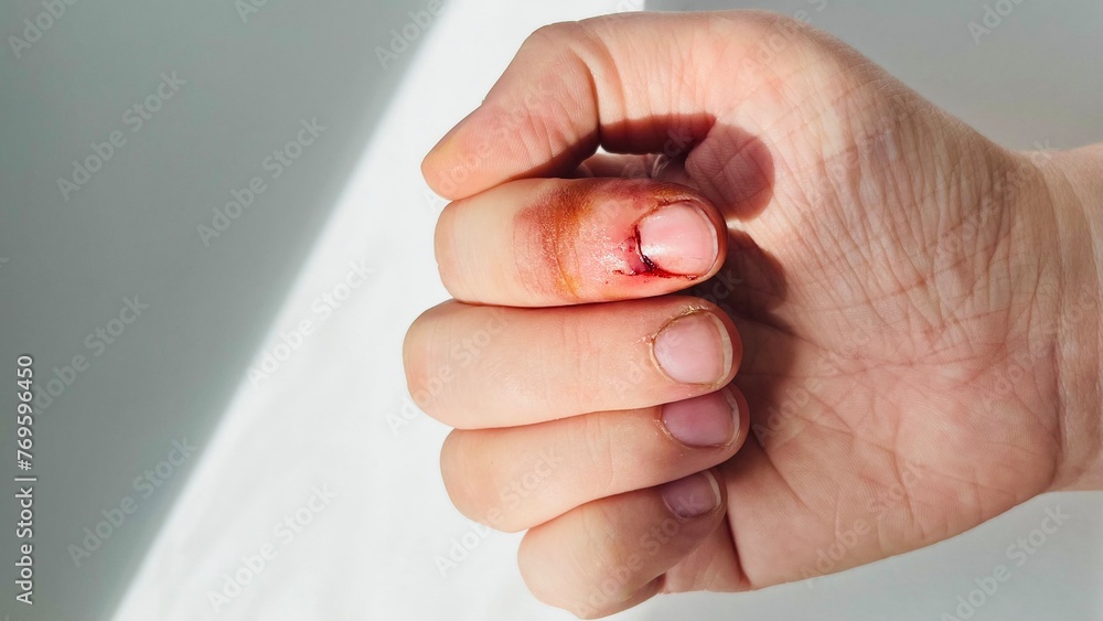 the right hand after a dog bite on the index finger is bent into a fist ...