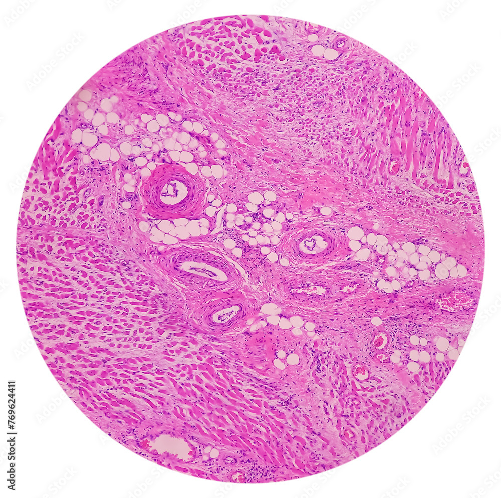 Microscopic image of above knee amputation. Section show fibro ...