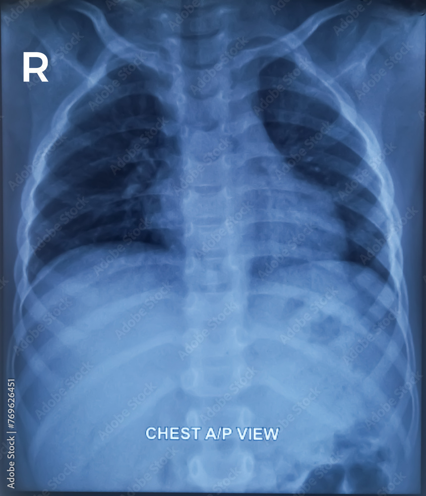 Pneumonitis(right), CXR (Chest X-Ray) PA view. Hypersensitivity ...