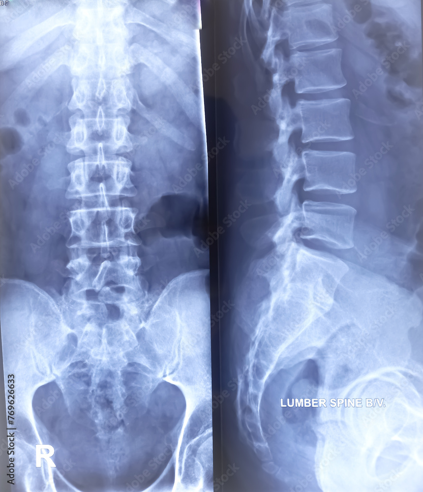 Lumbo sacral (LS) spine x-ray both view. Straightining of lumber ...