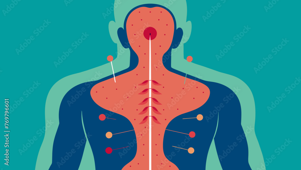 A view from above showing multiple needles positioned along a persons ...