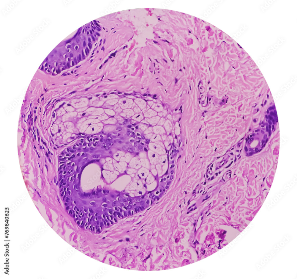 Hand skin tissue (biopsy) : Prurigo nodularis. Microscopically show ...