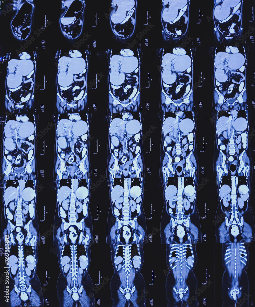 CT (Computed Tomography) scan of Whole abdomen. Soft tissue mass in ...
