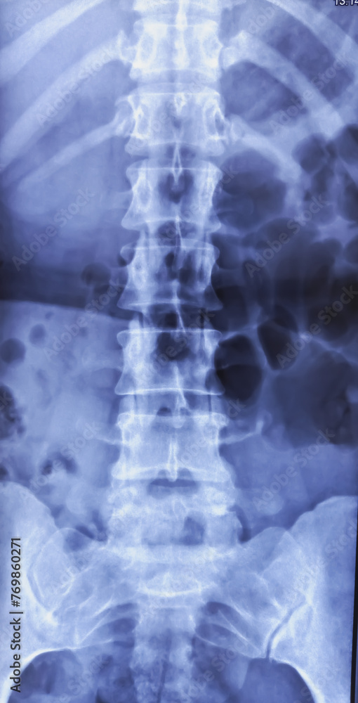Lumbosacral spine x-ray AP view. Lumber spondylosis. Straightining of ...