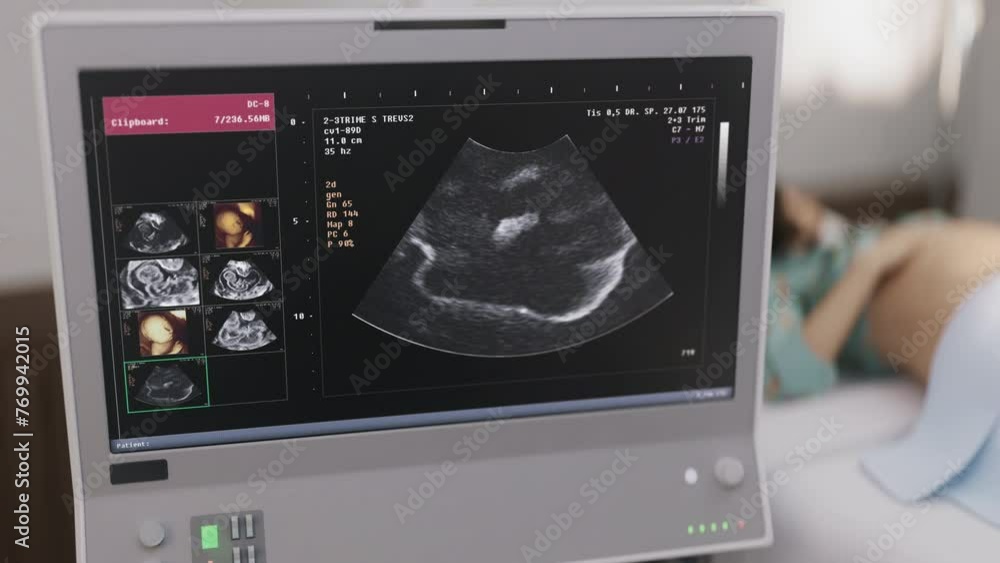Ultrasound examination of the woman carrying a child. Checking the ...