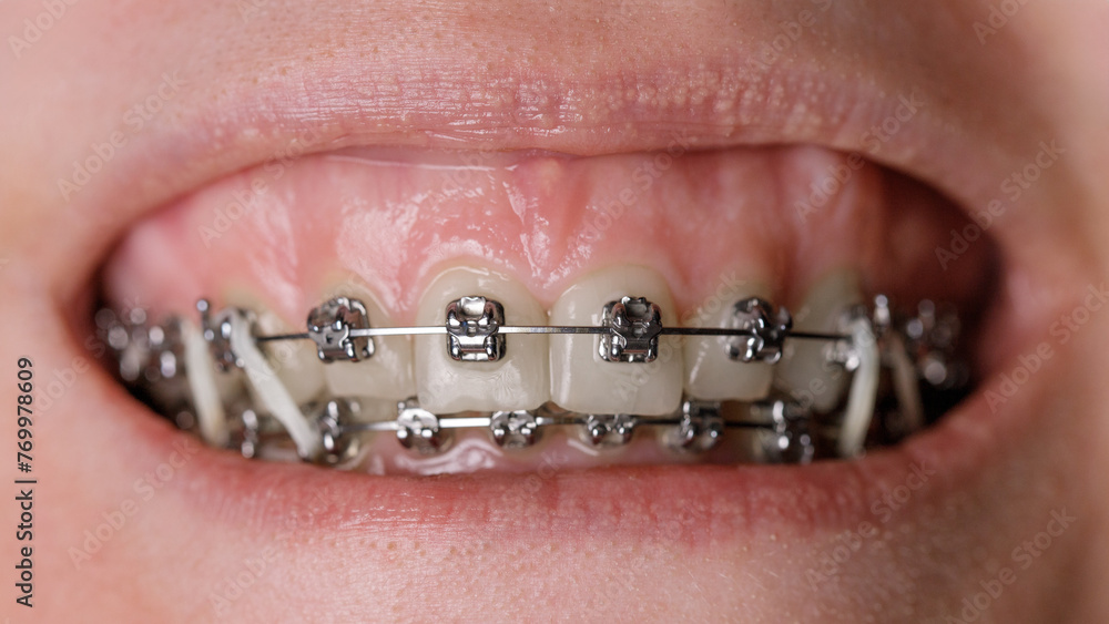 Metal orthodontic braces on crooked teeth close-up. Gummy smile. Dental ...