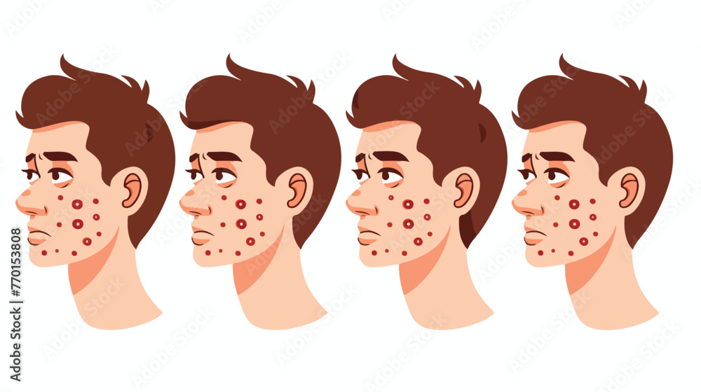 Cartoon Stages of acne formation in the human skin Stock Vector | Adobe ...