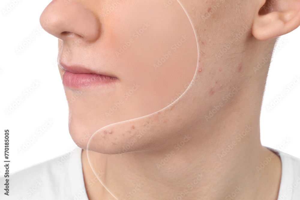 Acne problem, collage. Photo of man divided into halves before and ...