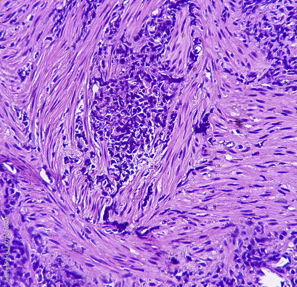 Sigmoid colon (colonoscopic biopsy): Chronic nonspecific colitis. Show ...