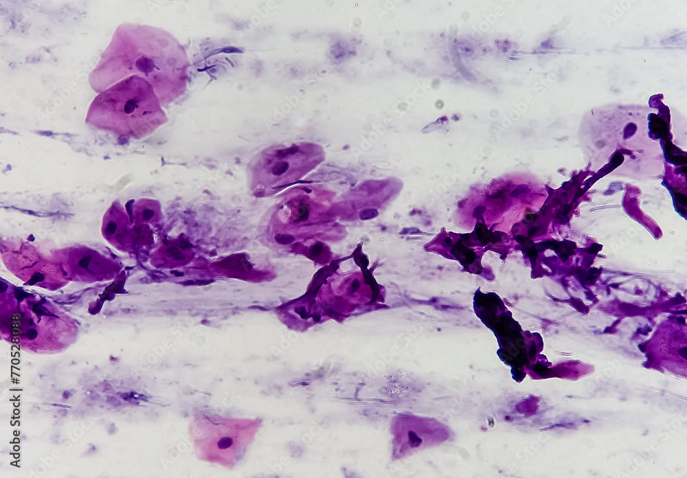 Light micrograph of a vaginal smear showing adenocarcinoma cells ...