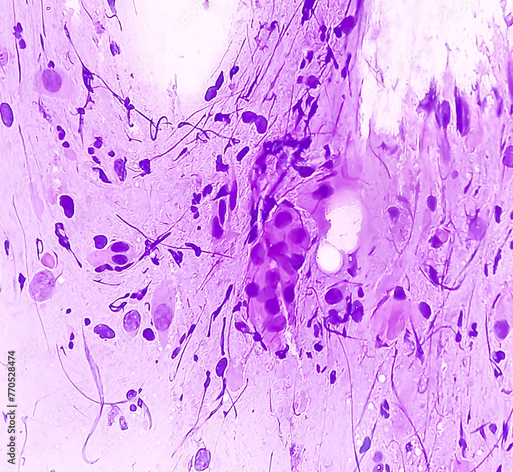 Light micrograph of a vaginal smear showing adenocarcinoma cells ...