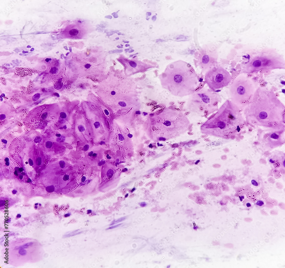 Light micrograph of a vaginal smear showing adenocarcinoma cells ...