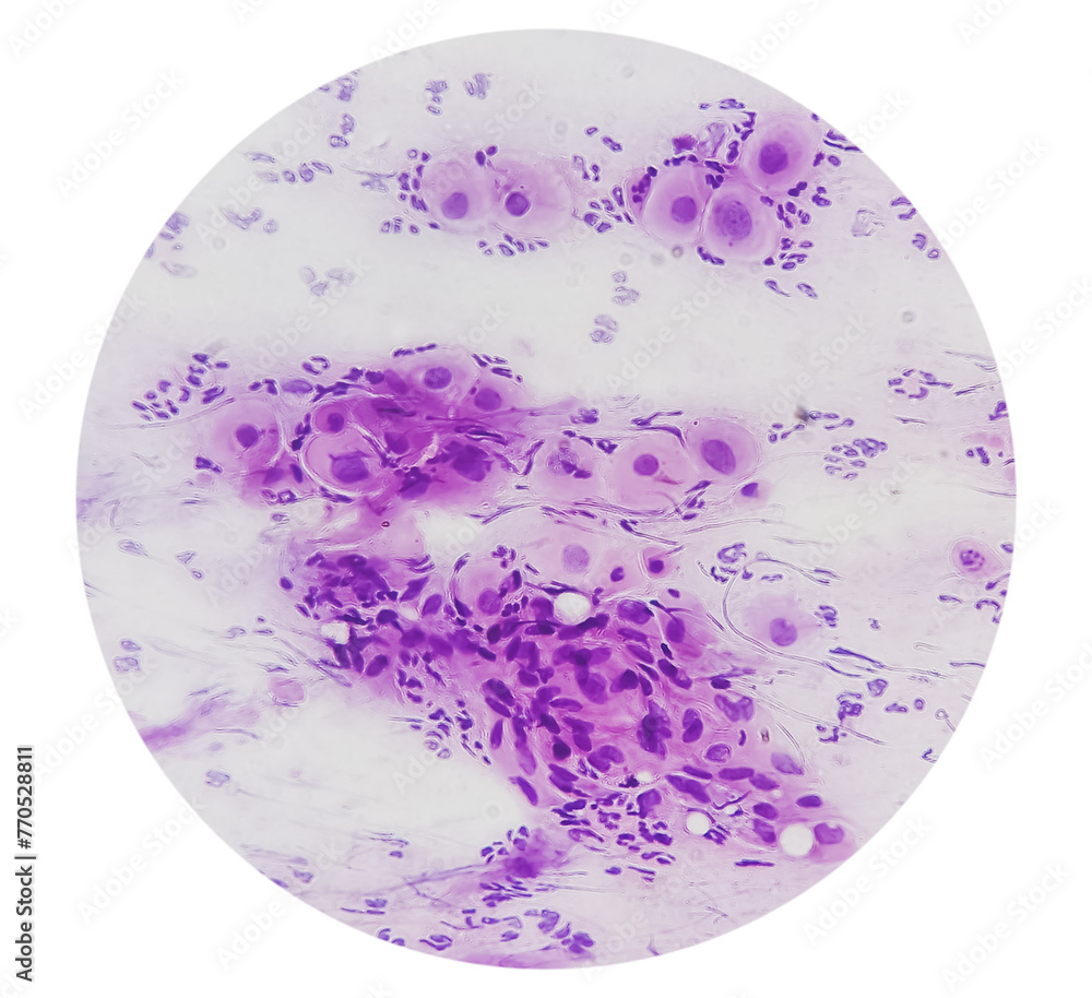 Light Micrograph Of A Vaginal Smear Showing Adenocarcinoma Cells