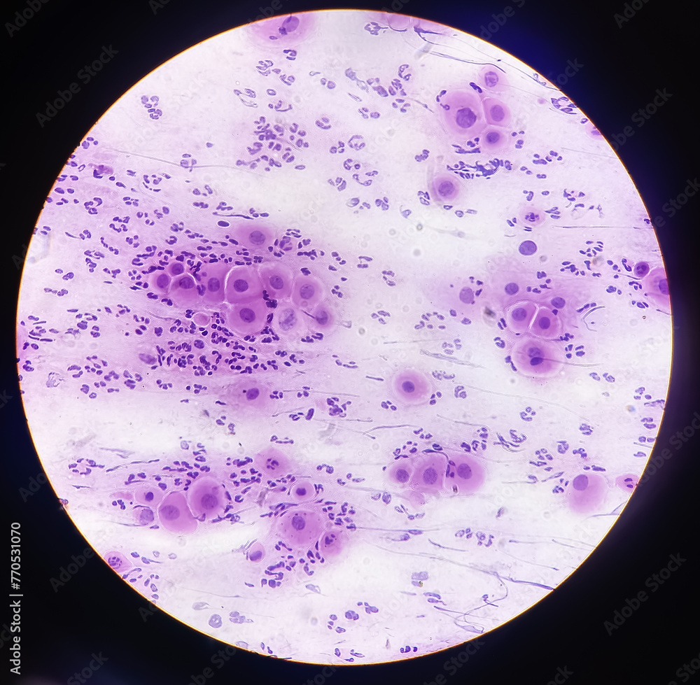 Light micrograph of a vaginal smear showing adenocarcinoma cells ...