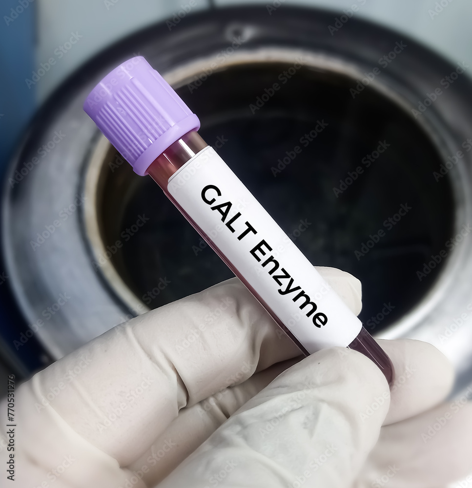 Blood sample for Galactose-1-phosphate uridylyltransferase (GALT) test ...