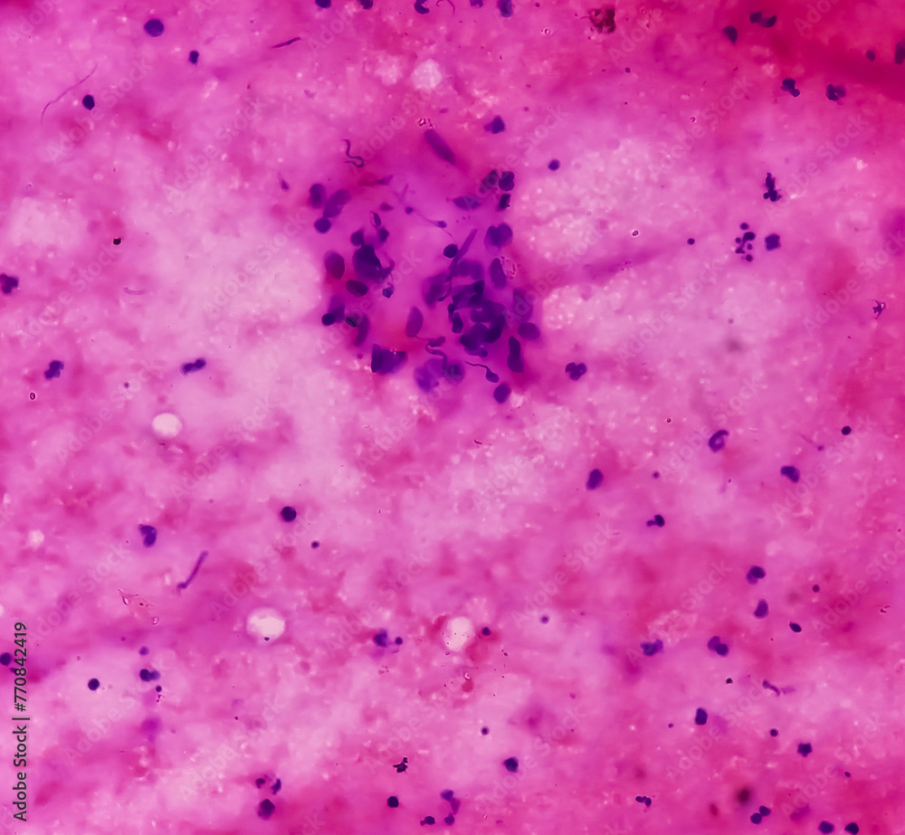 FNA from paravertebral mass. Suppurative inflammation. Smear show ...
