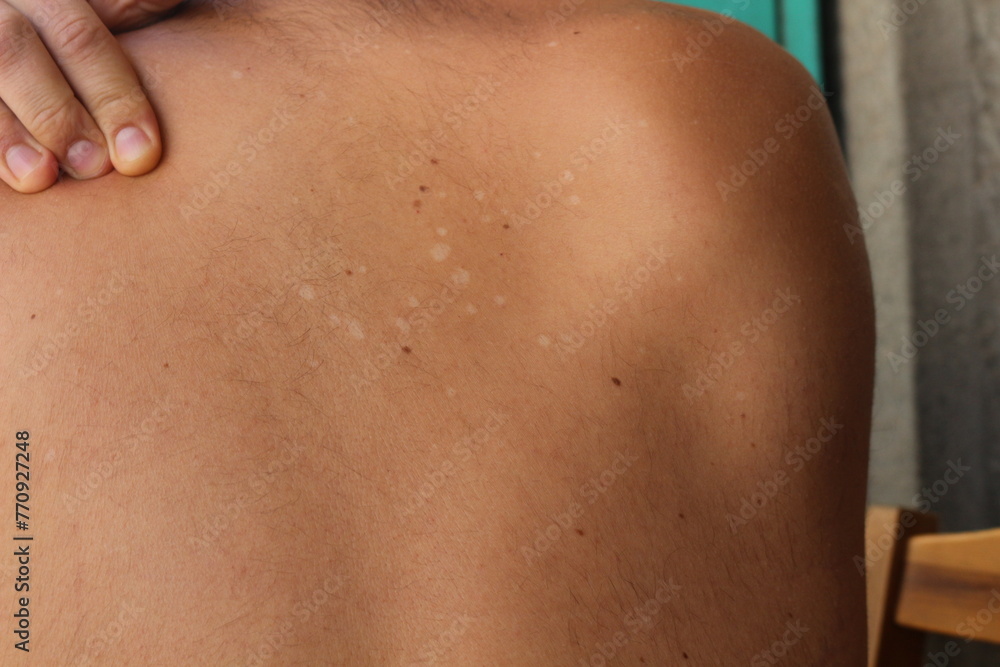 Poster Understanding Tinea Versicolor: Managing and Treating Pityriasis ...