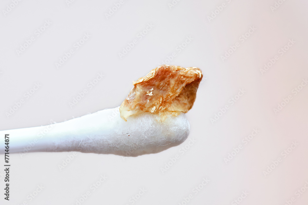 Ear wax plug isolated on white background. Removed giant ear wax plug ...