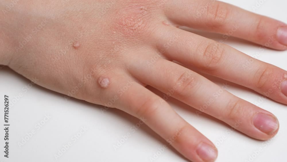 Child hand with common viral warts Verruca vulgaris - flat warts, close ...