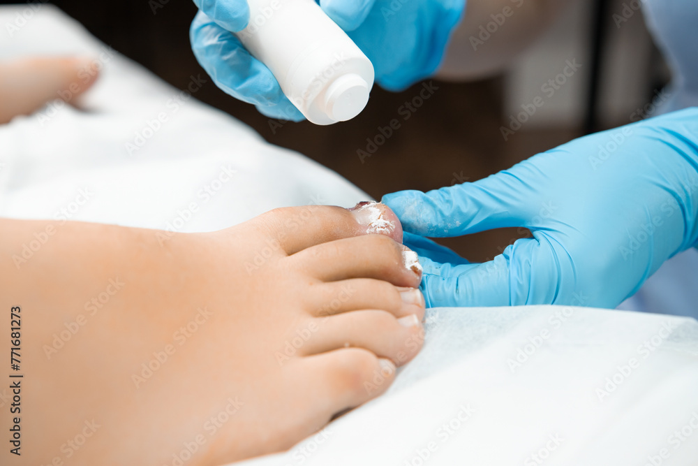 Application of antibiotic powder proves effective in combating toenail ...