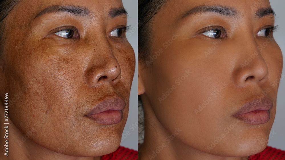 Foto de Freckles and Spot melasma pigmentation skin facial treatment ...