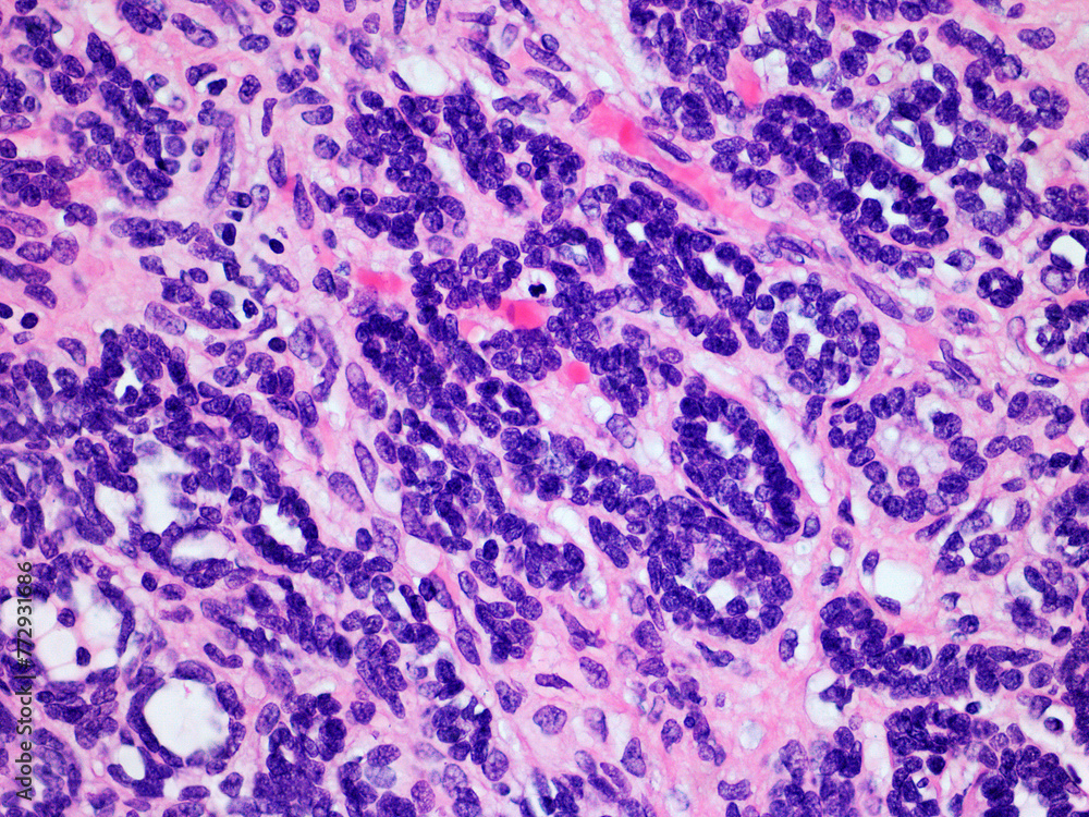 Microscopic Image of a Wilms Tumor or Nephroblastoma of a Childs Kidney ...