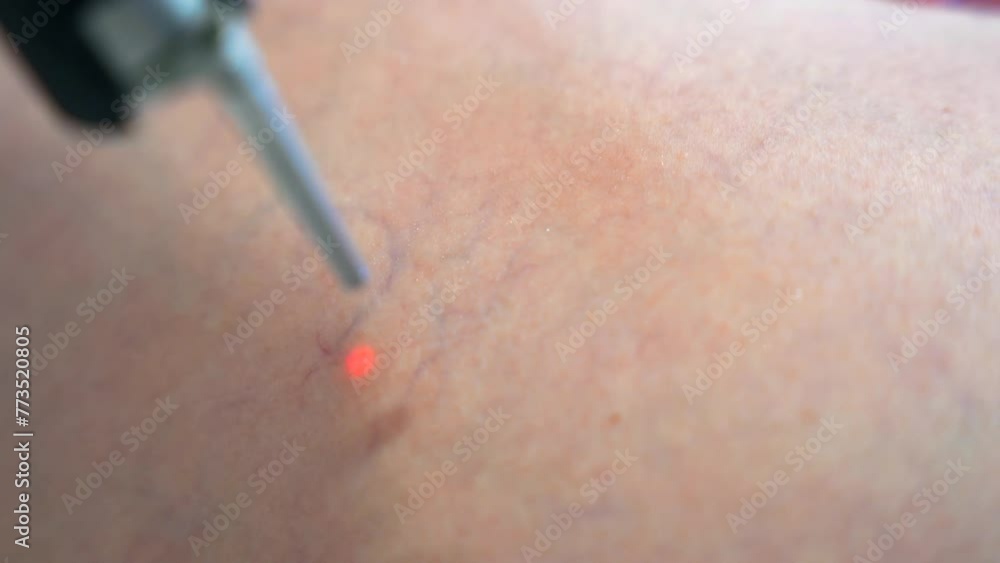Close-up shot of Removal of blood vessels with a laser. Removal of red ...