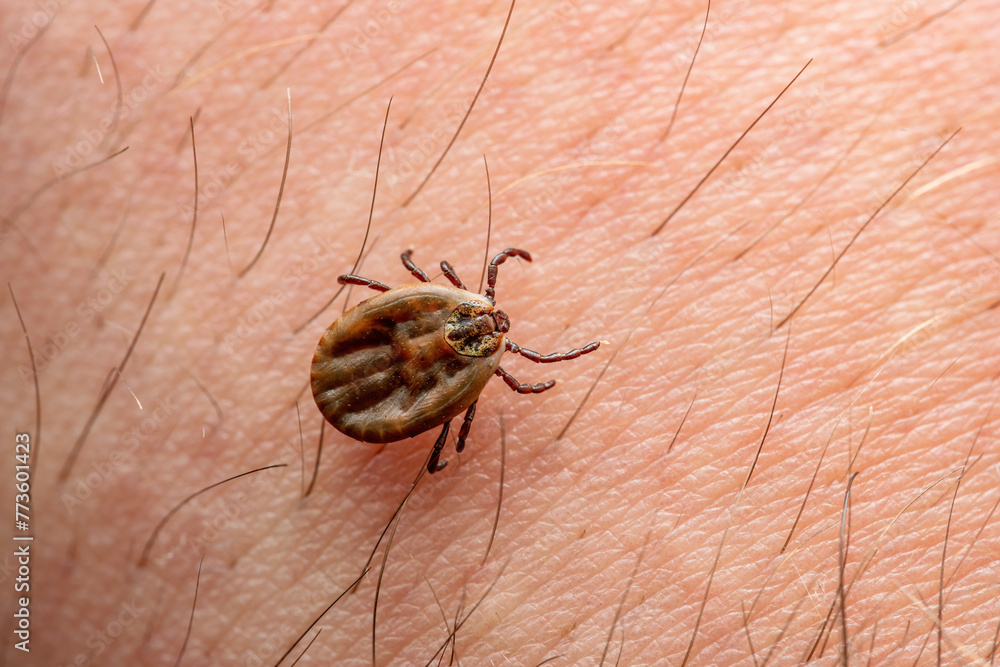 Infectious Encephalitis Tick Insect on Skin. Encephalitis Virus or Lyme ...