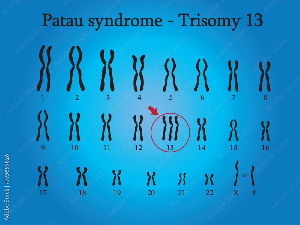 Karyotype of Patau syndrome also known as trisomy 13, is a genetic ...