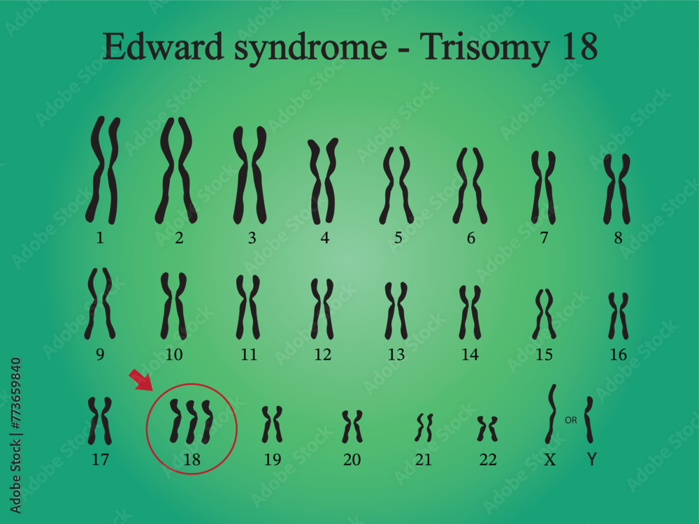 Karyotype of Edward syndrome also known as trisomy 18 is a genetic ...