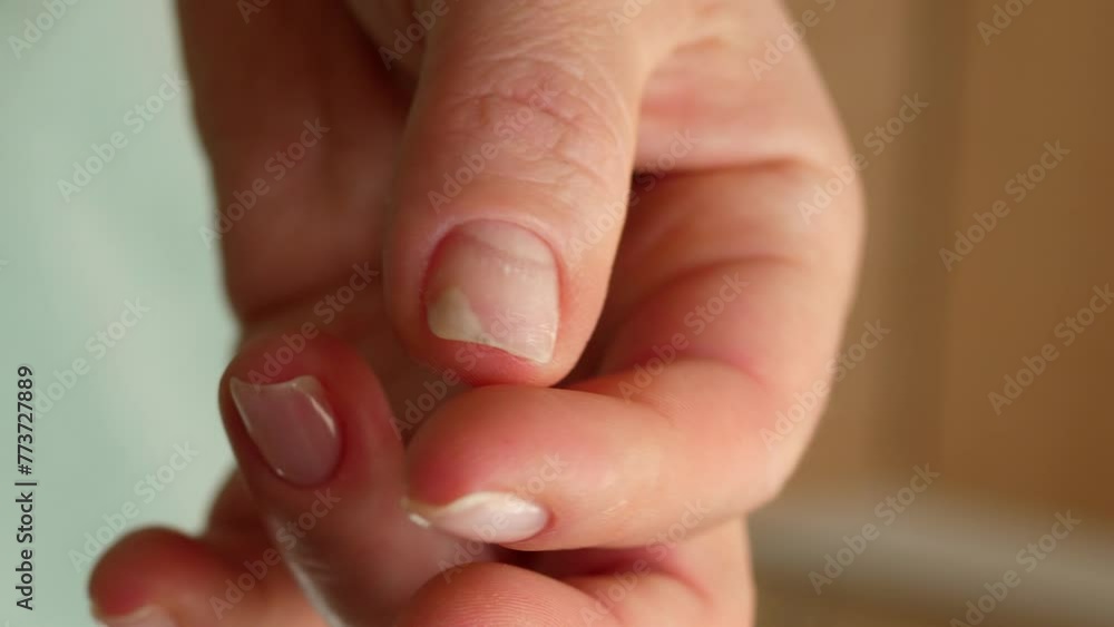 Vidéo Stock Close-up of a damaged detached nail on a woman's hand ...