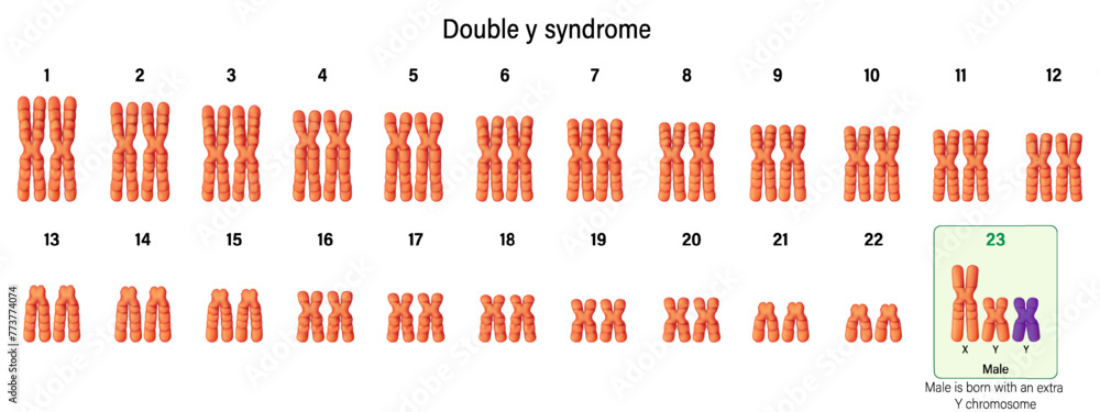 Karyotype of Double y syndrome. Male has an extra Y chromosome. A rare ...