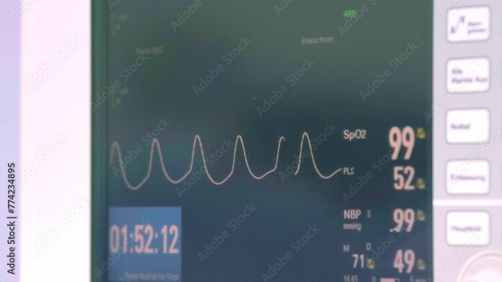 Monitor of the heart rhythm in the operating room. Medical vital signs ...