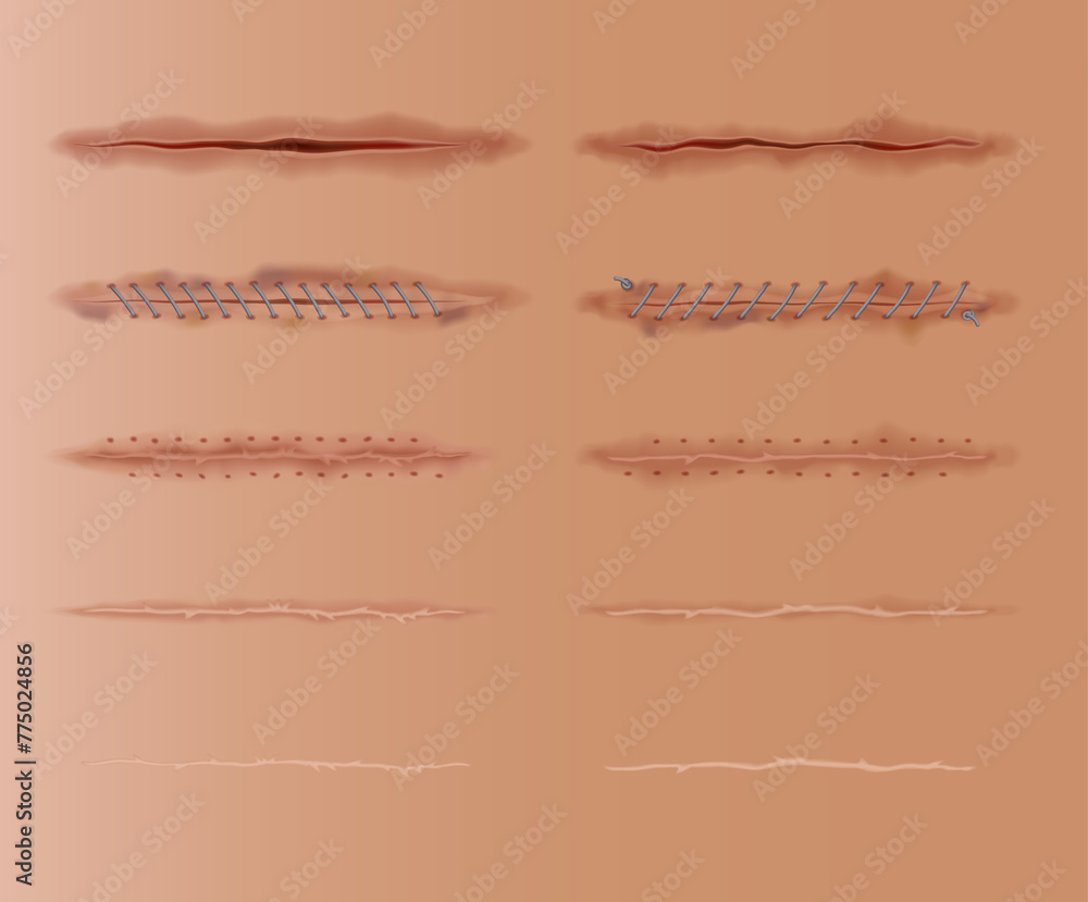 Set of healing wounds, skin scars, stitched gash and cuts. Realistic ...