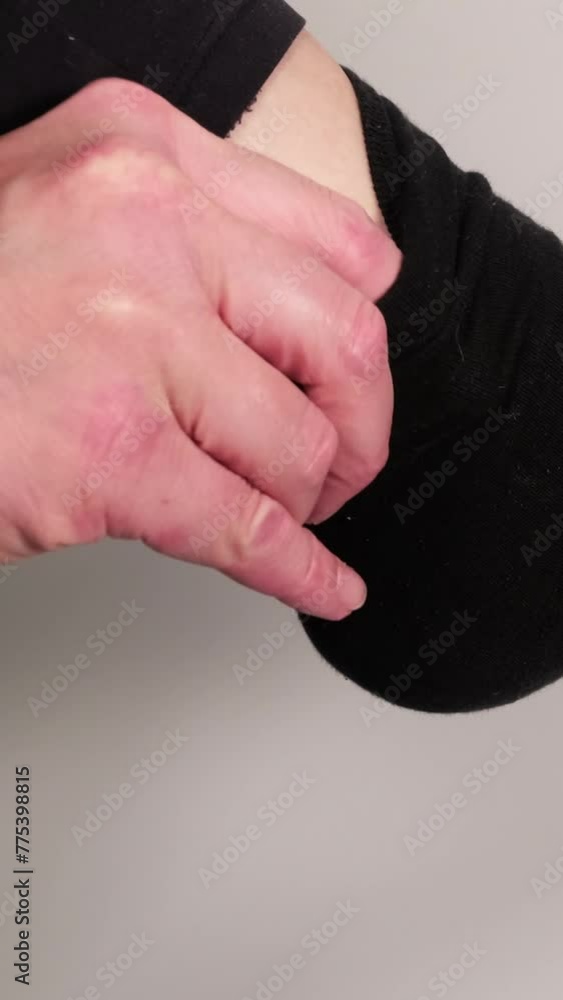 Painful inflammations on female foot after several confluent blisters ...