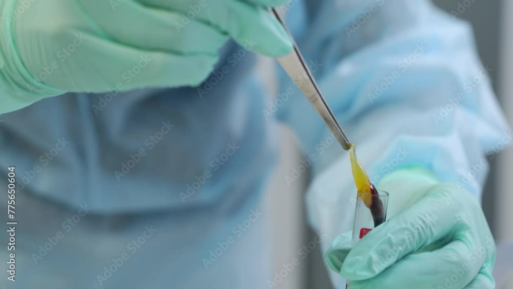 PRF platelet rich fibrin in dental surgery. Dentist's hands working ...