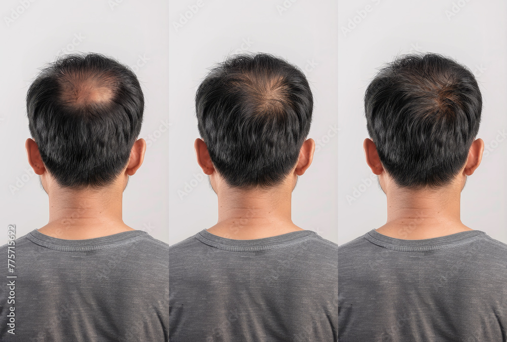 back side of a man with hair loss problem. comparing before and after ...