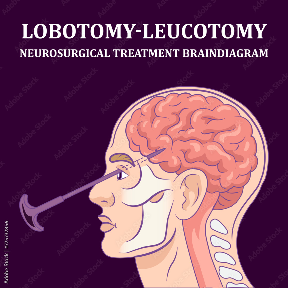 Brain Diagram: Lobotomy leucotomy neurosurgical treatment in brain ...