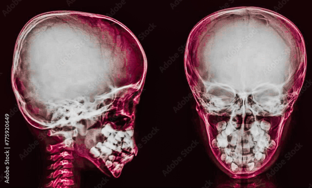 normal skull x ray anterior and lateral view Stock-Foto | Adobe Stock