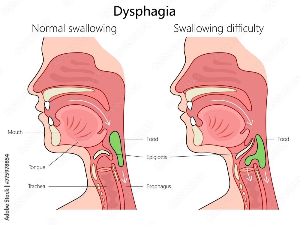 Póster dysphagia swallowing difficulty and normal swallowing with labeled anatomy structure ...