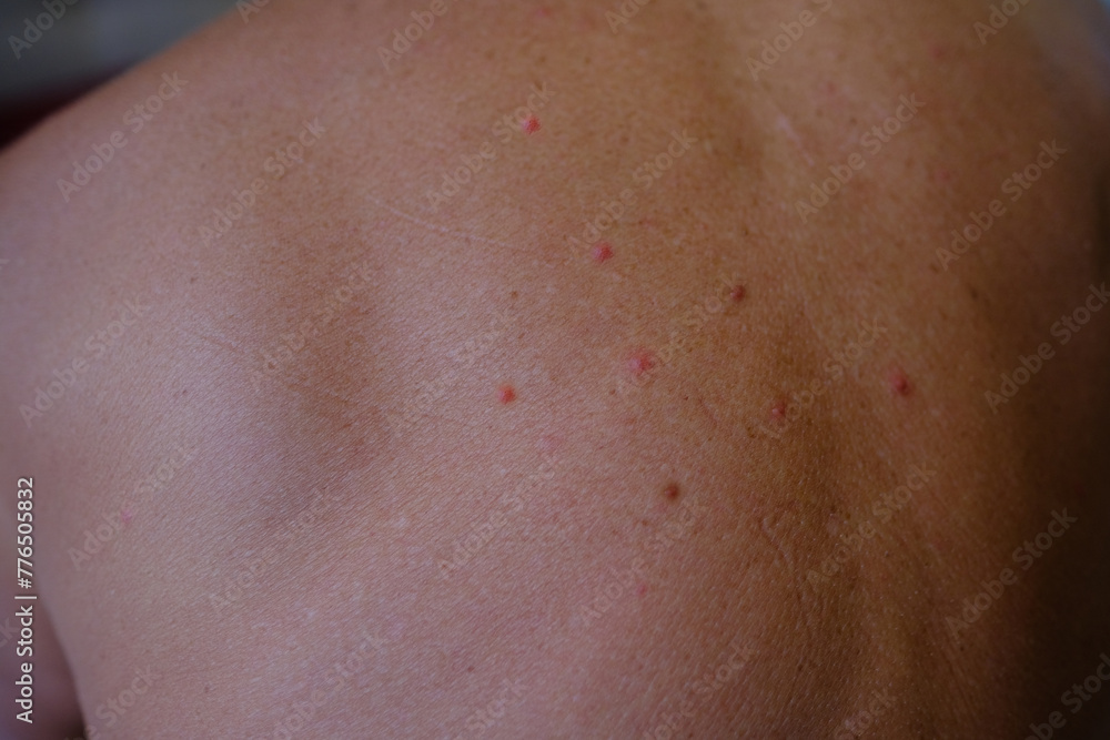 itchy rashes on skin, close-up injured male back, skin bitten by ...