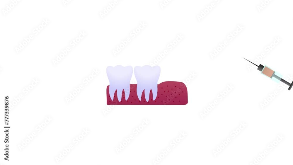 swelling around the tooth extraction site animated video, elevator ...