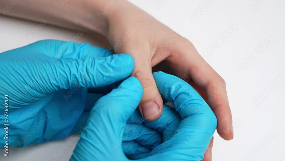Vidéo Stock Doctor holds child hand with warts on thumb. Papillomavirus ...