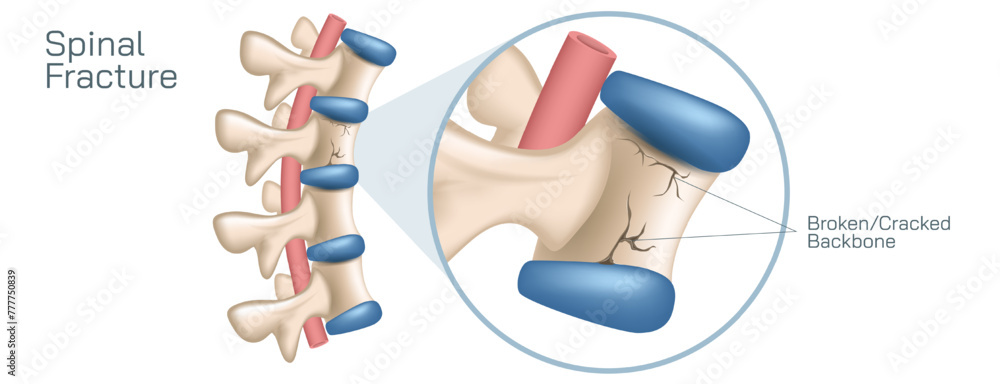 Backbone spinal cord compression fracture. Vertebra and compression or ...