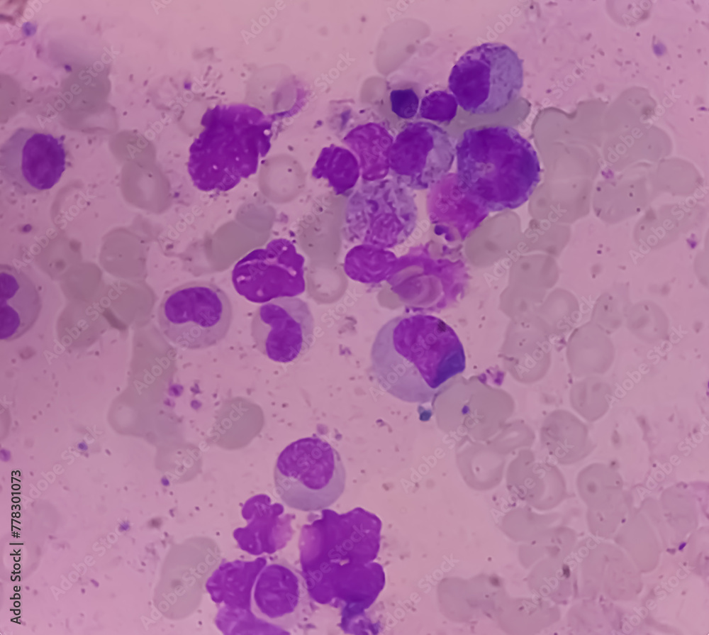 Bone marrow study. Reactive marrow with dimorphic erythroid hyperplasia ...