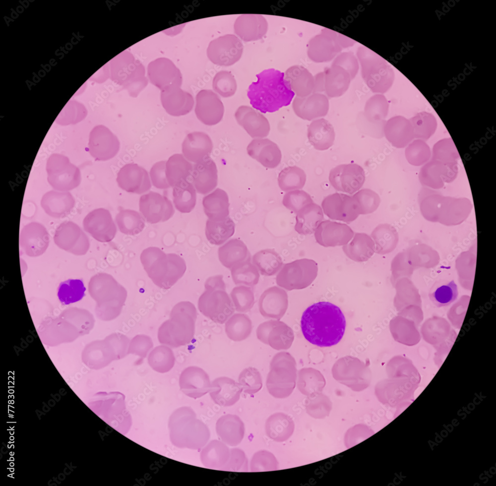 Bone marrow study (BMD). Myelodisplastic syndrome (MDS) or Refractory ...