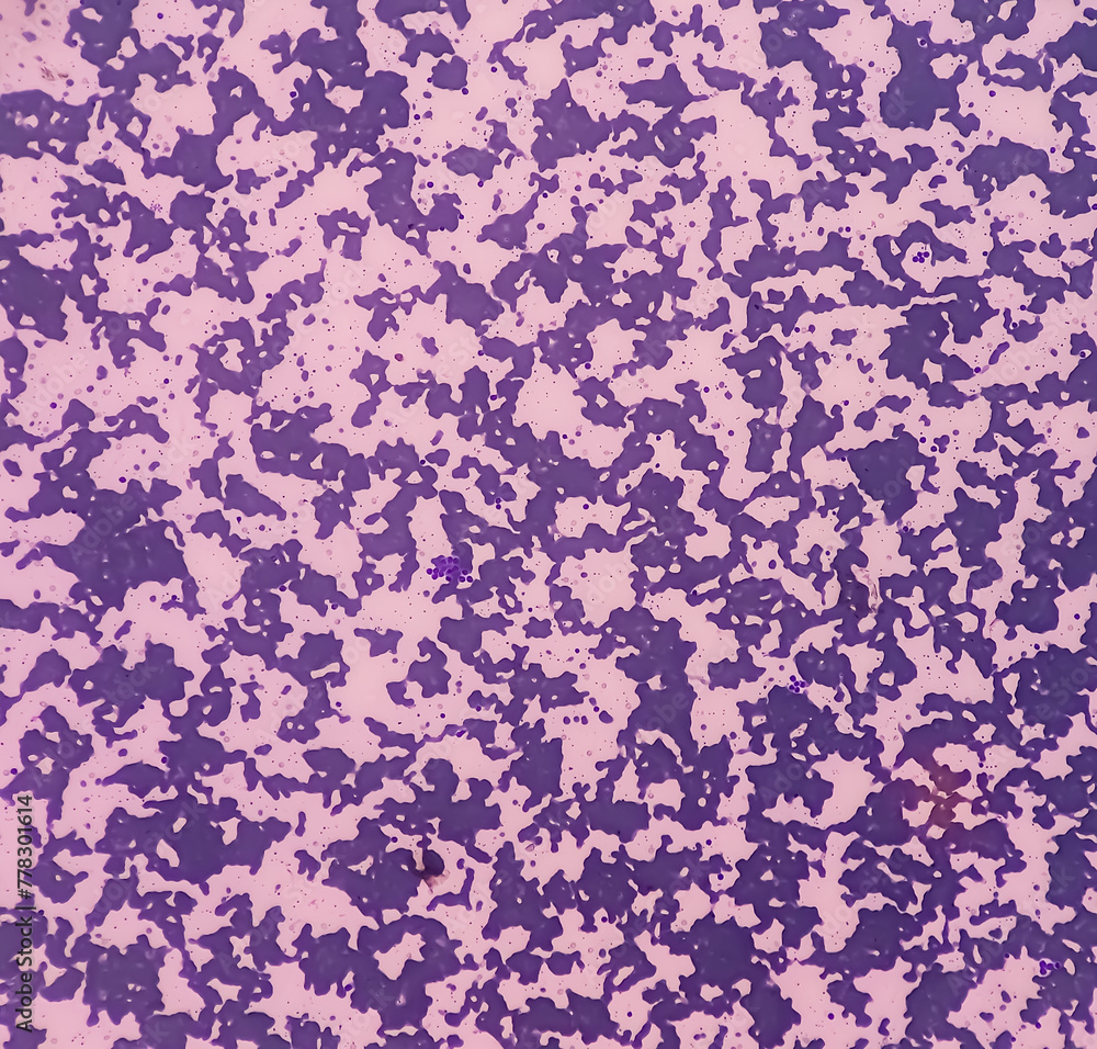 Cold agglutinins disease, RBCs to clump together (agglutinate) at low ...