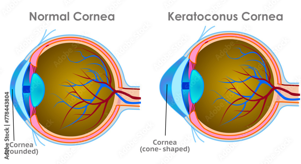 Keratoconus cornea, astigmatism see. Eye anatomy, retina optic ...