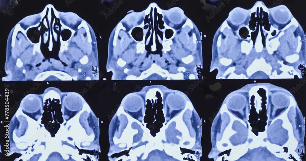 CT scan of PNS: Hypertrophied both inferior nasal turbinates with ...